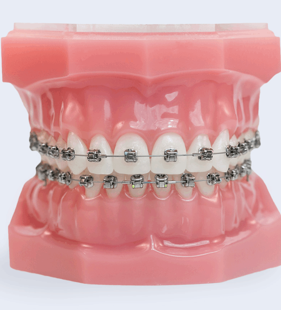 LightForce Clear Braces | Marris Orthodontics | Braces in Orlando